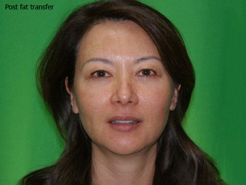 Dermabrasion | Plastic Surgeon in Poway, San Diego CA